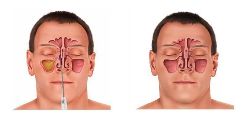 Sinus & Breathing Relief in Los Angeles - Sinus Center LA